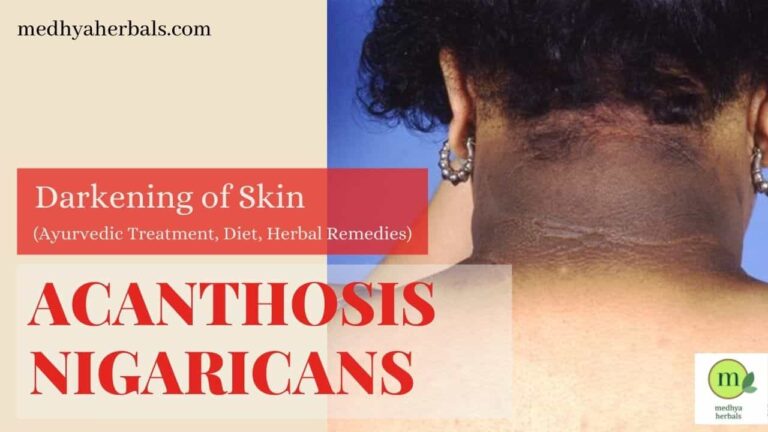 Acanthosis Nigricans Treatment: The Best Ayurvedic Tips For Dark Neck
