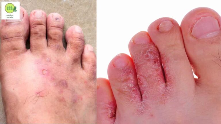 Athlete’s Foot Fungus Treatment: Easy Ayurvedic Ways to Cure Infection