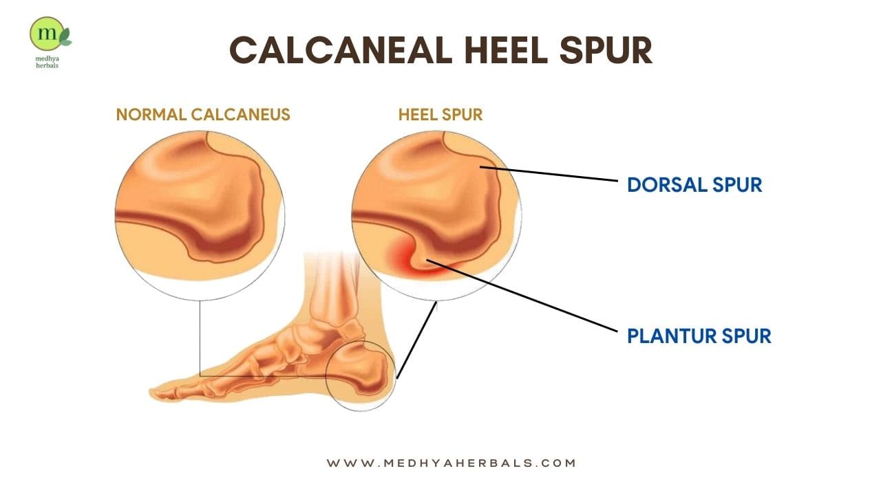Heel Spur Treatment: The Best Ayurvedic Remedies for Pain